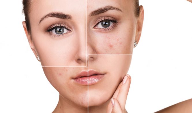 Acne: wat kun je eraan doen? - ForYou Magazine